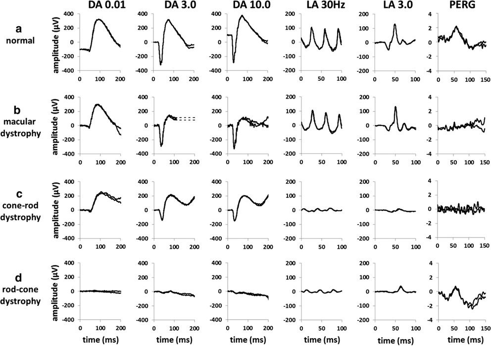 Electroretinogram (ERG) and Electrooculogram (EOG) - Ophtha.info